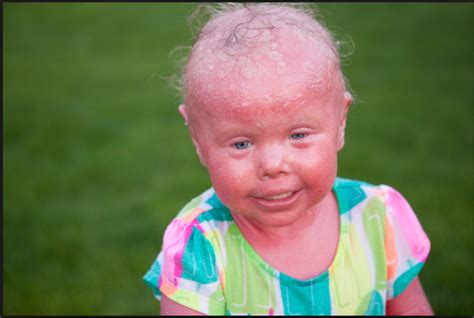 Pin On Rare Disease Saturday