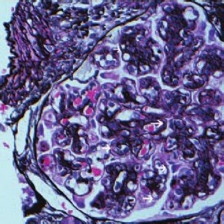 Evaluation Of MPGN On The Basis Of IF Findings MPGN Can Be Broadly Download Scientific
