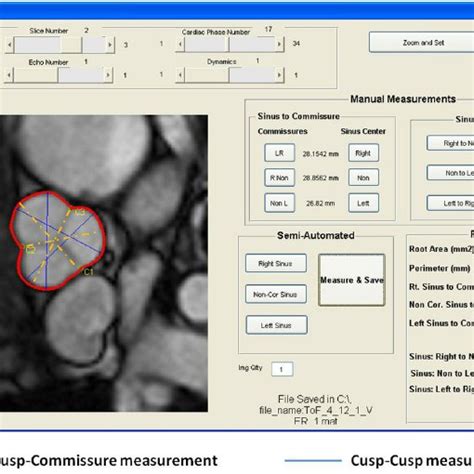 Tool For Accurate And Consistent Measurement Of The Aortic Root