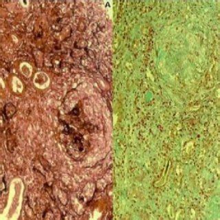 A Glomeruli With Complete Encircling Cellular Crescents Interstitium Download Scientific