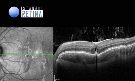Choroidal Rupture Oct