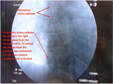 Video Fluoroscopy For Positioning Of Pulmonary Artery Catheters In