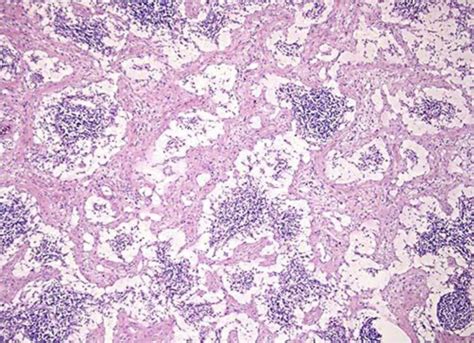 Histological Section With He Staining Of The Resected Myofibroblastic Download Scientific