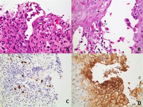 A Intranuclear And Cytoplasmic Inclusions Characteristic Of Cmv