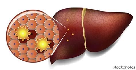 Печень не болит Вот самый простой способ узнать здоровая ли она у вас В 90 печень оказывается