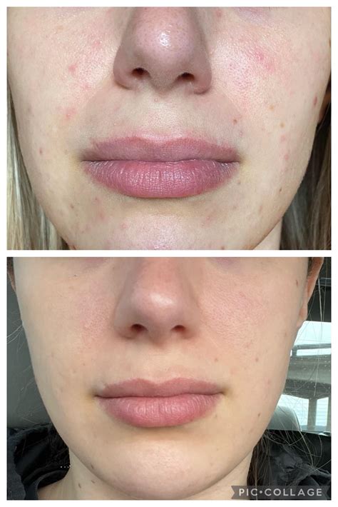 200 Best Azelaic Acid Images On Pholder Skincare Addiction Tretinoin And Rosacea