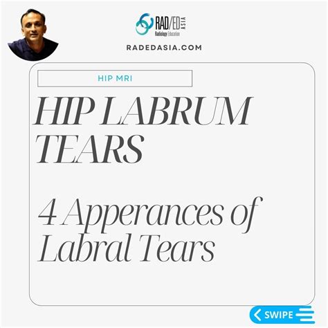 Hip Labrum Labral Tear Mri Radiology Radiology Education Asia