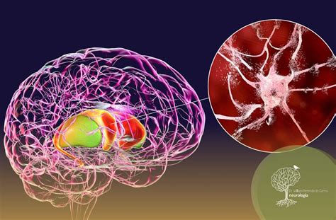 Como Identificar A Doença De Huntington Neurologia Hoje Neurologia
