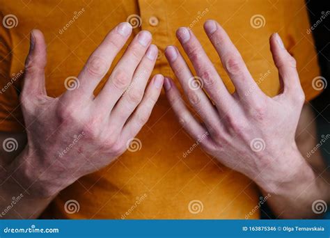 Psoriasis Skin Closeup Of Rash And Scaling On The Patient`s Skin The Concept Of Chronic