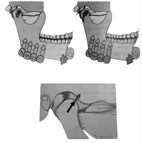 Occlusal Splint Flashcards Quizlet