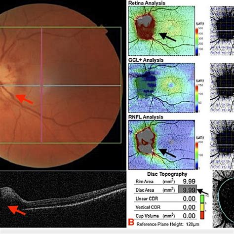 Oct Showing Abnormal Optic Disc A Optic Disc Is Pale And Edematous