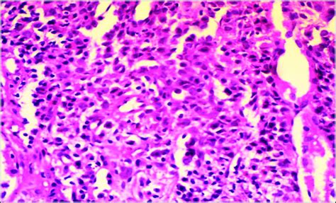 Final Histological Section Of The Gastrectomy Specimen Showing Single