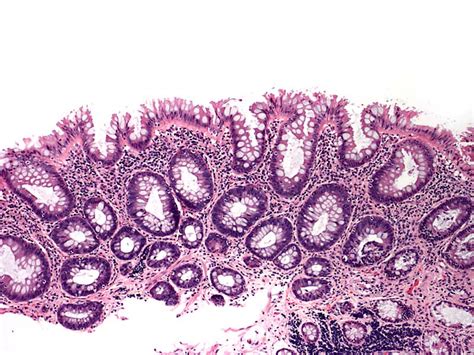Serrated Polyps Quiz