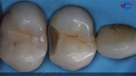 Premolar Class Ii Youtube