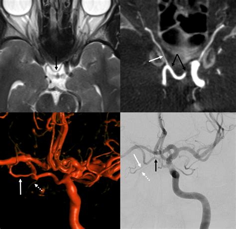 Meningohypophyseal Trunk