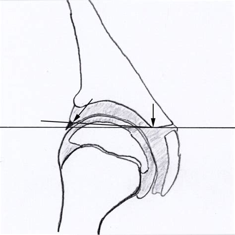 Measurement Of The Cartilaginous Acetabular Index Measured From The Mri Download Scientific