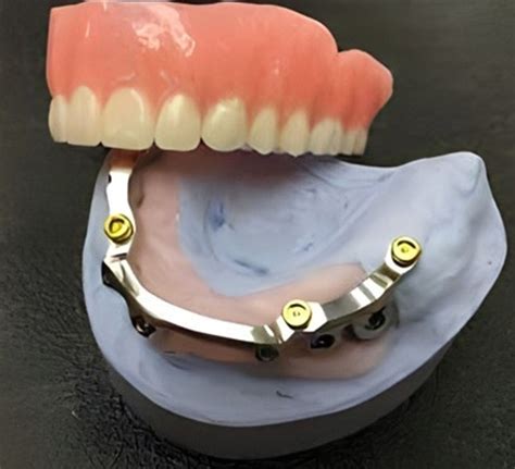Flexible Denture Solutions Yorba Linda Oral Surgery