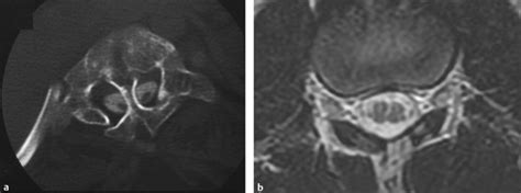 Occult Spinal Dysraphism Neupsy Key