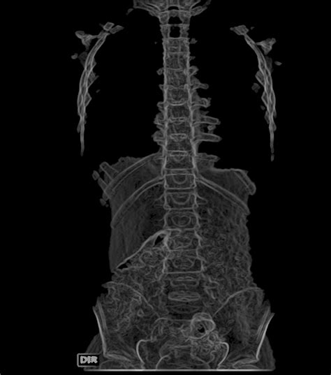 X Ray Vertebrae Detection Opencv Qanda Forum