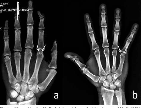 Figure 4 From Prevalence And Distribution Of Sesamoid Bones Of The Hand