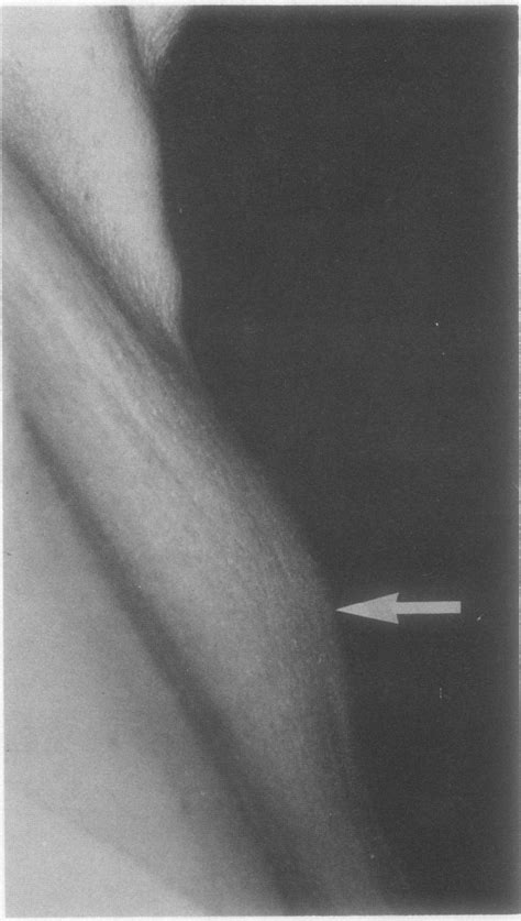 Manubriosternal Joint