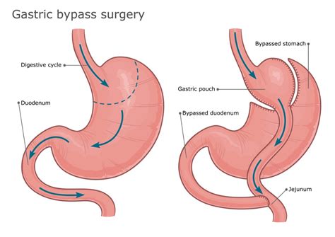 Laparoscopic Gastric Bypass Surgery In Los Angeles