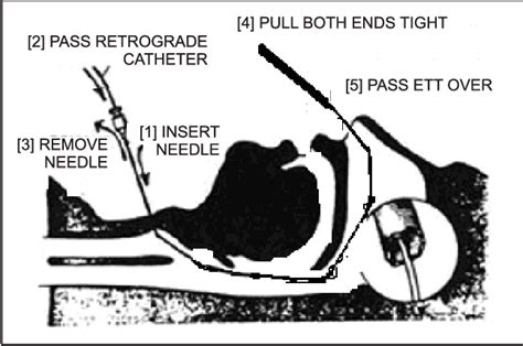 Figure 1 From Retrograde Intubation In A Case Of Ankylosing Spondylitis Posted For Correction Of