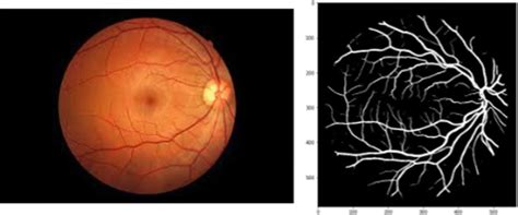 segmented retina calculation of artery vein ratio download scientific diagram