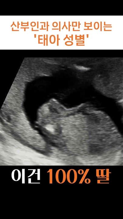 산부인과 의사는 초음파 사진만 보고 성별을 맞출 수 있을까 Youtube