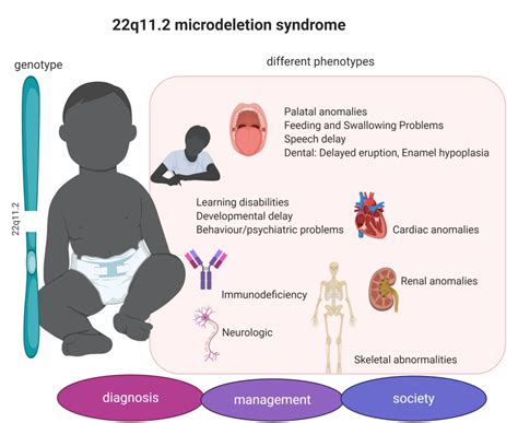 Digeorge Syndrome 22q112 Deletion Syndrome