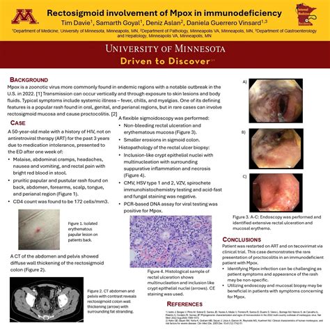 Rectosigmoid Involvement Of Mpox In Immunodeficiency Timothy Davie