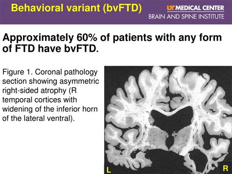 Ppt Frontotemporal Dementia Ftd Powerpoint Presentation Free