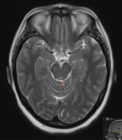 Quadrigeminal Plate Cistern Lipoma A Rare Case Report Eurorad