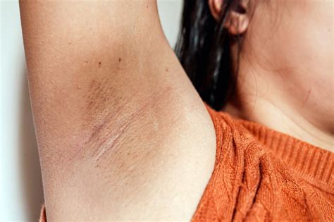 Stinky Armpit Red Rash Yellow Discharge Odor