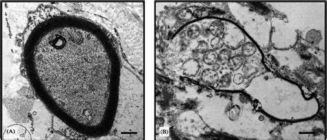 Human Myelinated Nerve Fibers Transmission Electron Microscopy Tem