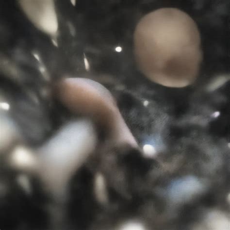 Ivc Thrombus Treatment A Comprehensive Overview