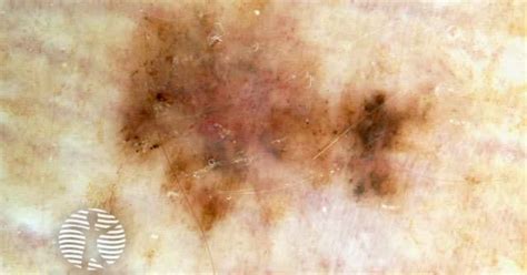 Dermnet® Dermoscopy Multicomponent Pattern Melanoma Image