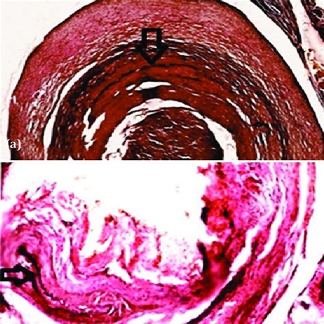 A B Avm Elastic Stain Highlights The Disruption Of Elastic Lamina