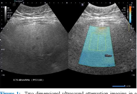Figure 1 From Novel Ultrasound Liver Attenuation Imaging For Detection Of Liver Steatosis
