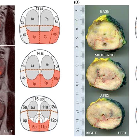 A Axial T2‐weighted Fast Spin‐echo Fused With Dwi B2000s Mm Using Download Scientific