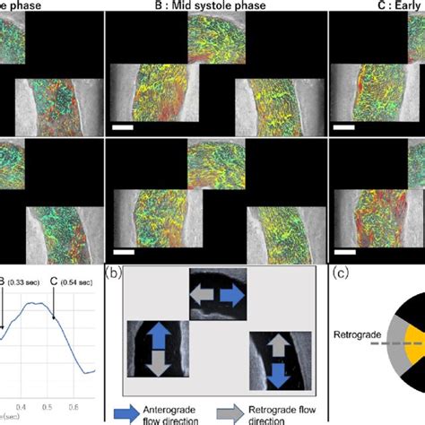 Screenshots Of The Vpi Cineloops Of Low Ecmo Flow Condition Upper Row