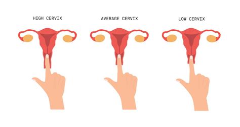High Vs Low Cervix