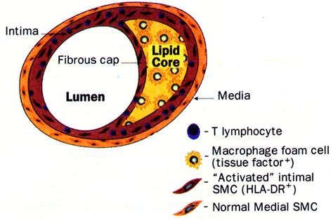 Atheroma More Than Mush The Lancet