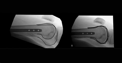 Second Generation Locked Nails Help Avoid Rotational Malalignment In Femur Fractures