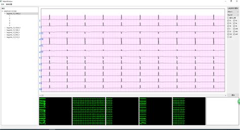 Qt开发之心电显示项目实现qcustomplot 心电图 Csdn博客
