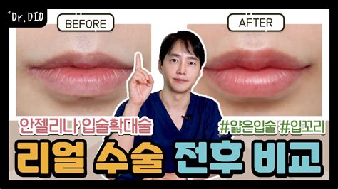 [eng 전후사진] 안젤리나 입술확대술 리얼 수술 전후 비교💋 Youtube