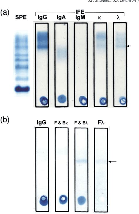 Table 1 From Serum Free Light Chain Analysis May Miss Monoclonal Light Chains That Urine