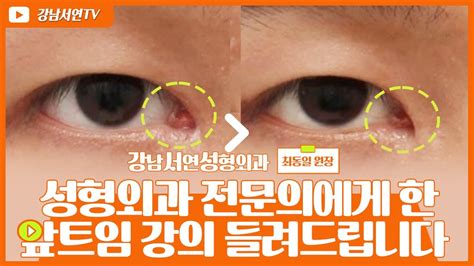 성형탐구 I 앞트임 L 성형외과 전문의들에게 했던 앞트임 강의 알기 쉽게 설명드려요 Youtube