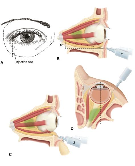 Retrobulbar Block American Academy Of Ophthalmology Retrobulbar Block American Academy Of Ophthalmology