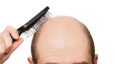 12 Of Historys Most Bizarre Baldness Cures